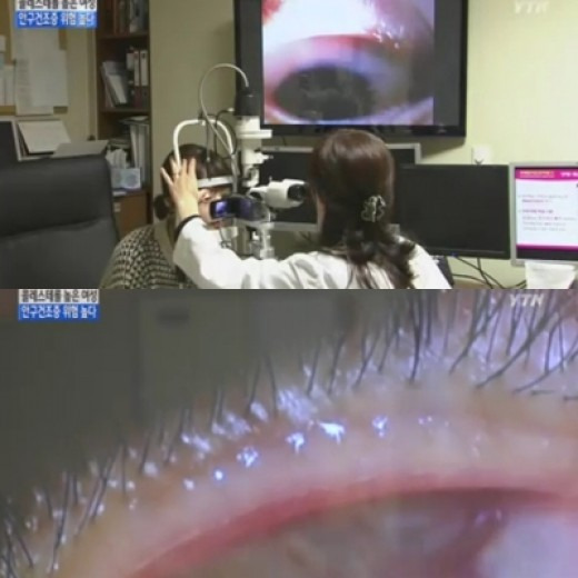 콜레스테롤 높으면 안구건조증 위험↑ 정상인 2배 눈물 증발