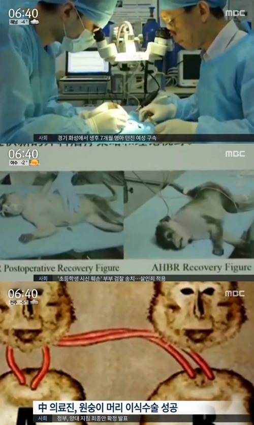 원숭이 머리 이식 성공 이탈리아 출신 의사프랑켄슈타인 박사로 불려
