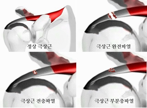 김영범의 건강돌직구 정상적인 퇴행변화로 발생하는 회전근개파열②