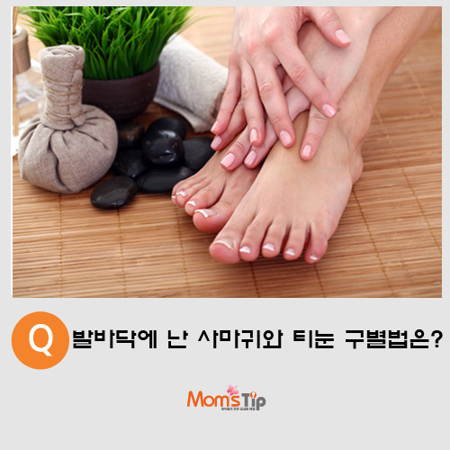 맘스팁 발바닥에 난 사마귀와 티눈 구별법은