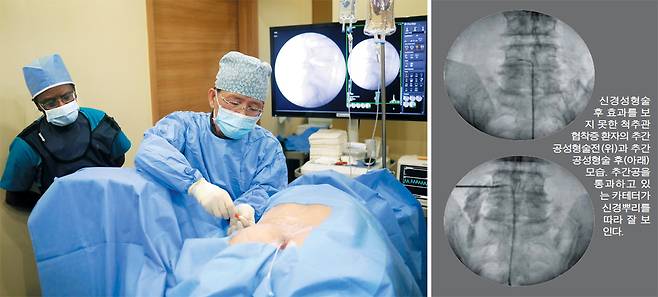 추간공 막힌 중증 척추관협착증 신경 뿌리쪽 통로 넓혀 통증 해결