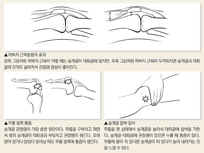 슬개골 관절염 통증 완화 허벅지 근육 키워 뼈에 닿는 압력 줄여야