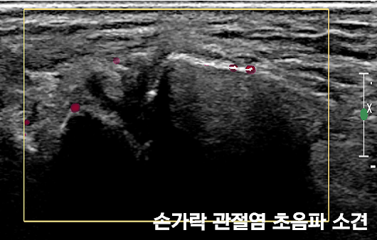 뻣뻣하고 붓고 아파요손가락 관절염과 류마티스 관절염이란