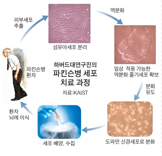 줄기세포로 파킨슨병 치료 10년 뒤엔 희망 보인다