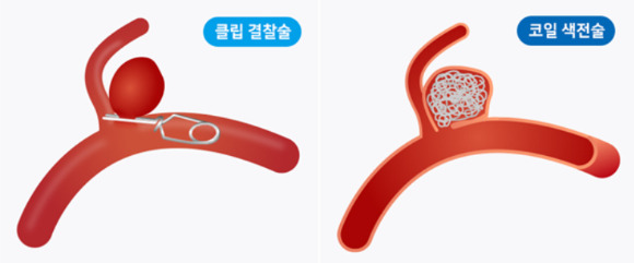 주말엔 건강 뇌혈관 풍선처럼 부풀어 오르면 큰일