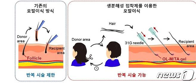 Kaist 모발 이식 가능 생체친화 의료 접착제 개발
