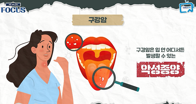 구강암 초기 5가지 증상 검사는 필수 서울대학교병원