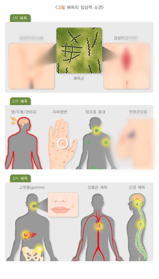 일본 덮친 매독 공포 우리나라도 확산 우려