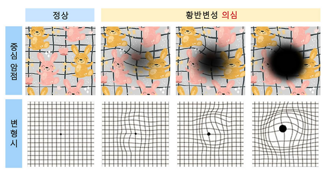 눈 건강 900냥인 이유 있었네”눈 질환 어르신들 골절도 더 당했다