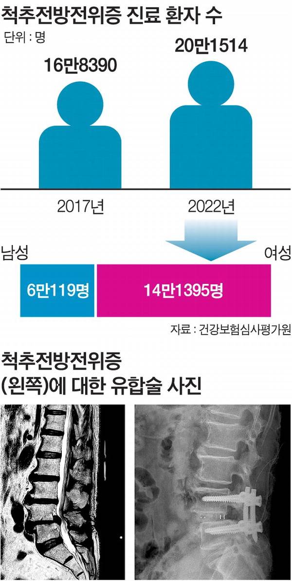 조금만 걸어도 허리·다리 통증척추전방전위증 의심을