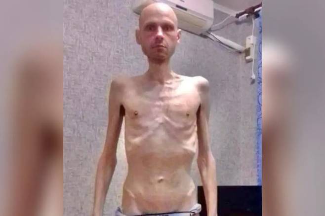 건장했던 체격이 앙상하게”20개월만에 풀려난 우크라 포로
