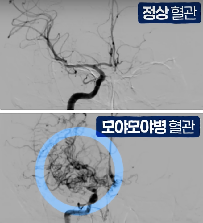 머릿속 연기가 피어오르듯··· 뇌혈관 이상 부르는 ‘모야모야병 악화 원인 찾았다
