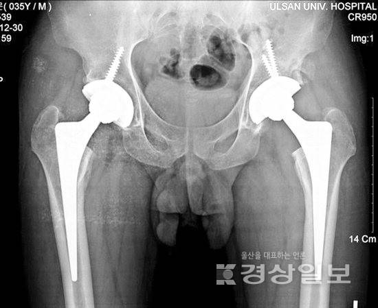 대퇴골두 무혈성괴사 양반다리 힘들거나 고관절 아프면 의심 경상일보