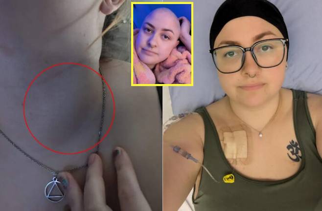 몸 가렵고 살 빠지더니30대女 목에 멍울까지 이 암 4기라고