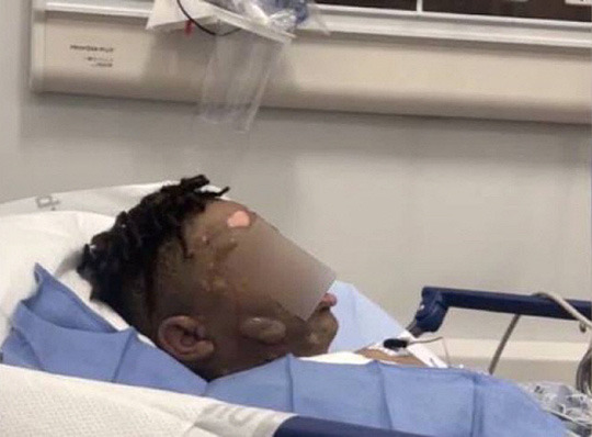 장난으로” 자는 친구 얼굴에 뜨거운 물 부은 무서운 美10대들