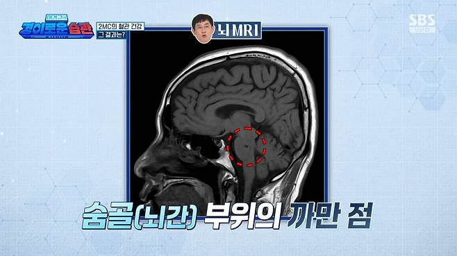 이경규 뇌경색·뇌졸중 진단 후유증 없어 천만다행 심하면 사망할 수도 경이로운 습관
